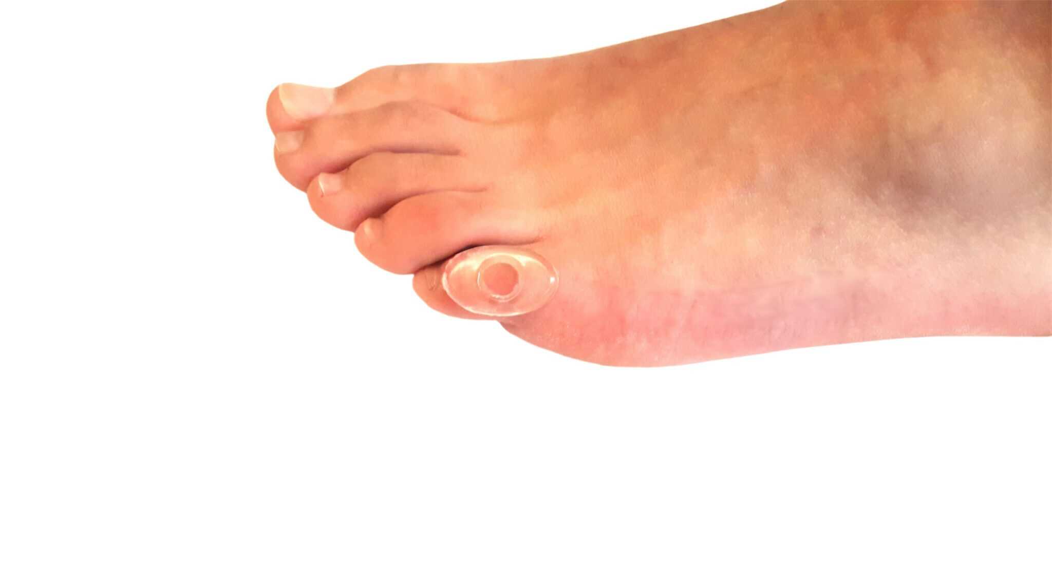 PhysiPod Gel Corn Pads (6 Pack) - Superior Relief From Painful Corns!